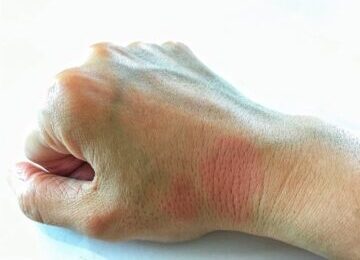 Specialist Lupus Treatment Brisbane | ArthritisCARE