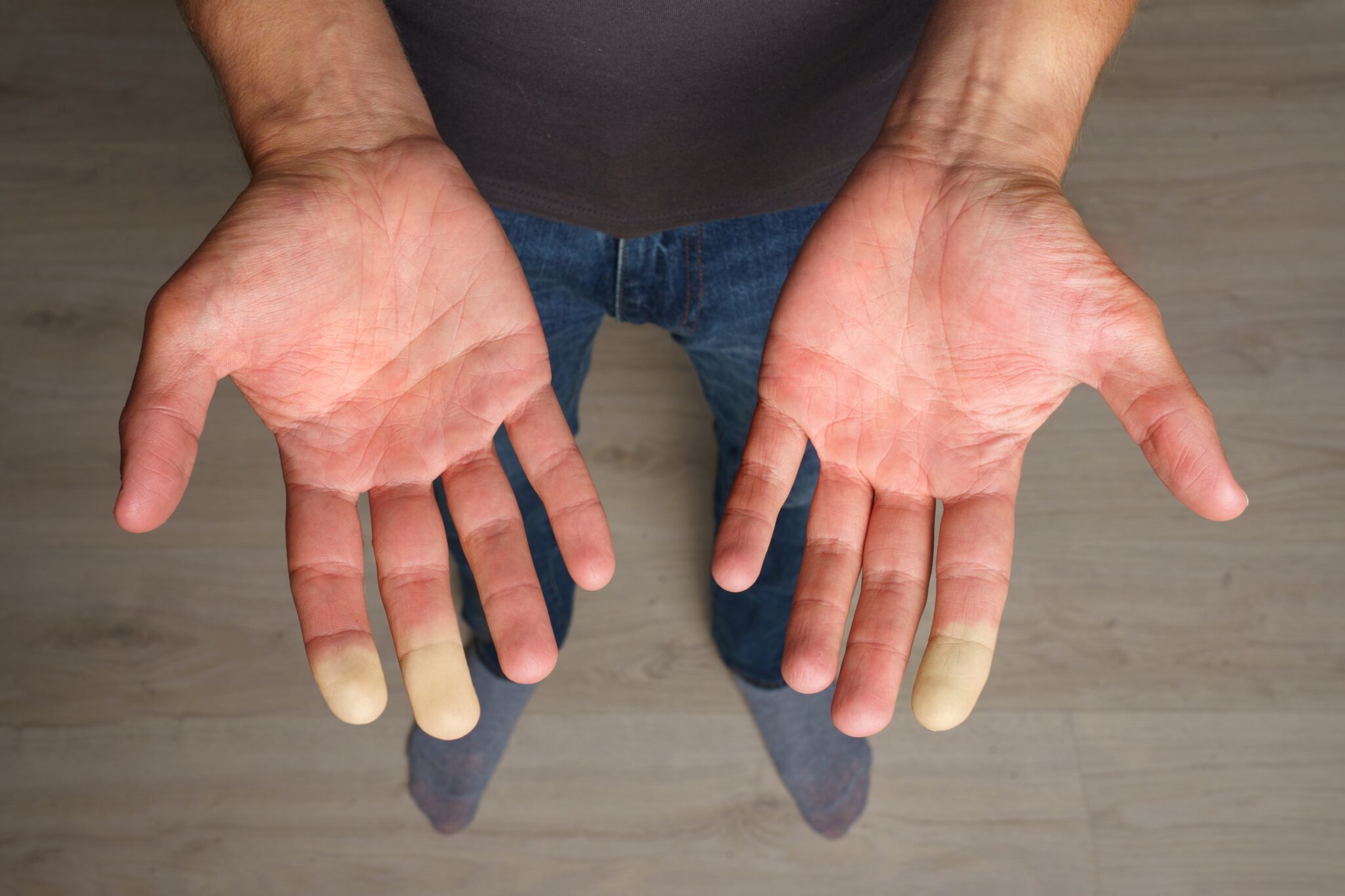 The Facts on Scleroderma Treatment in Brisbane | ArthritisCARE