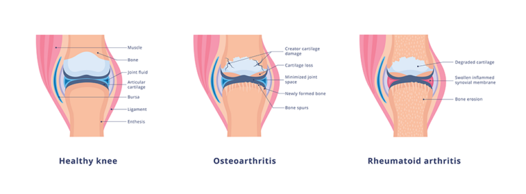 What is the Difference Between OA And RA | ArthritisCARE