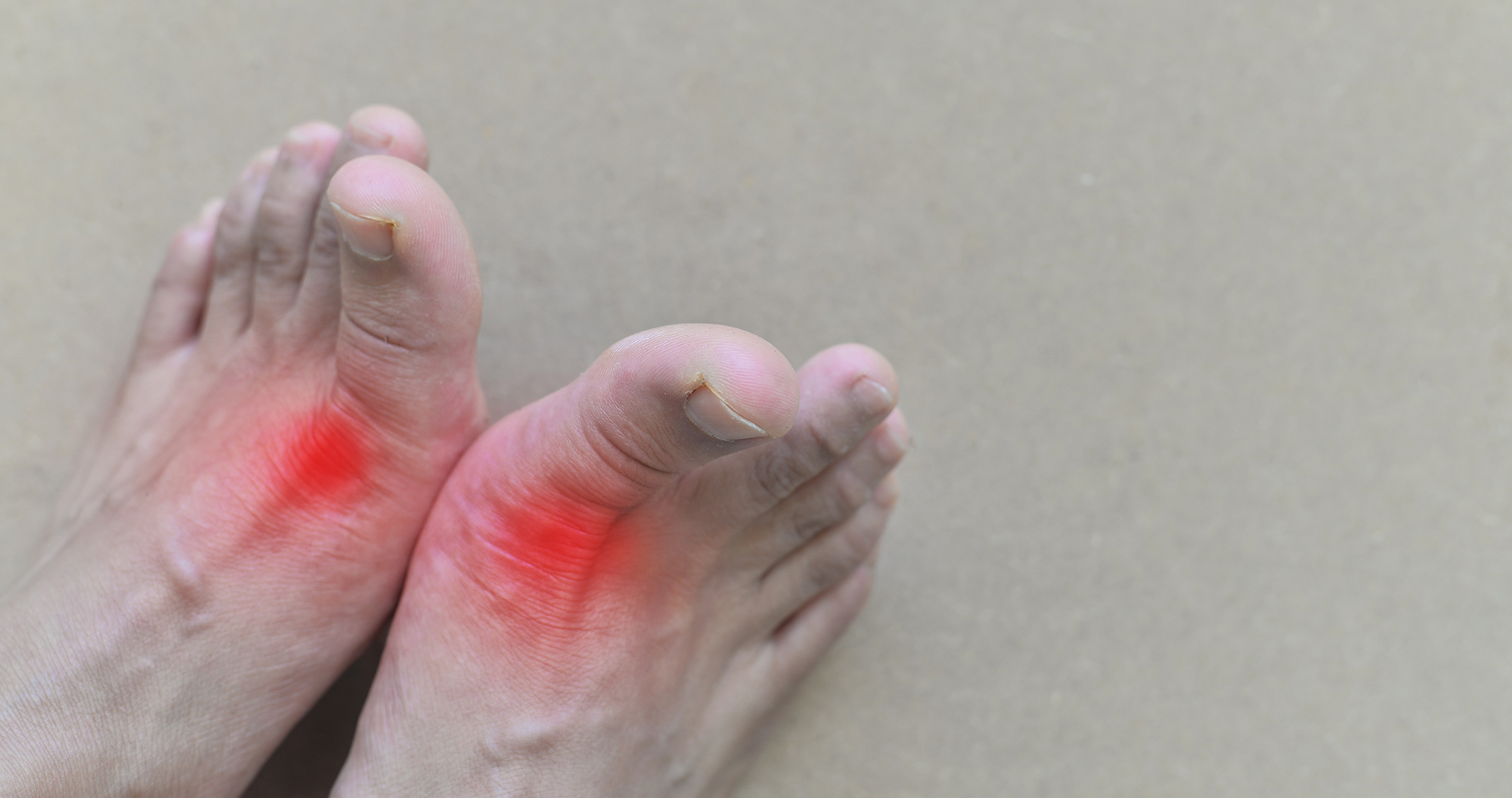 How To Get Rid Of Gout - Symptomatic Relief | ArthritisCARE